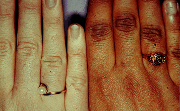 Addison’s Disease - The Clinical Advisor