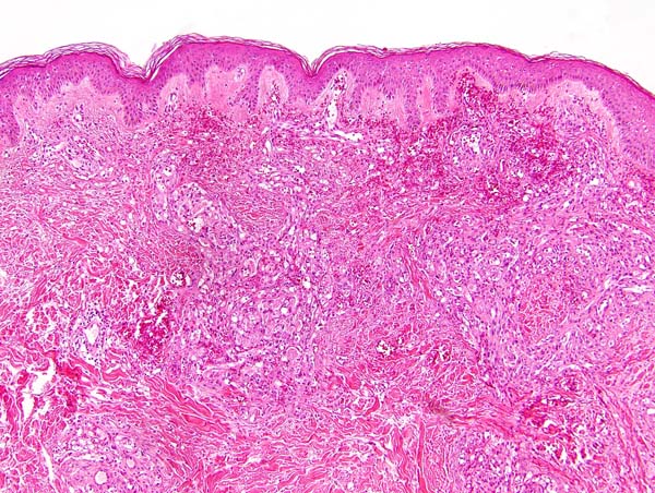 Cutaneous Reactive Angiomatoses (Angioendotheliomatosis, Diffuse Dermal ...