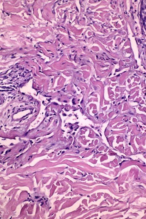 Angiosarcoma (Malignant hemangioendothelioma, Hemangiosarcoma ...