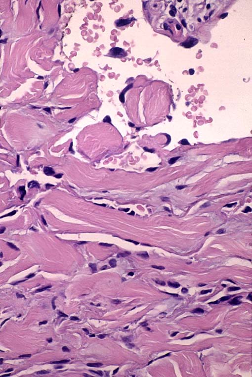 Angiosarcoma (Malignant hemangioendothelioma, Hemangiosarcoma ...