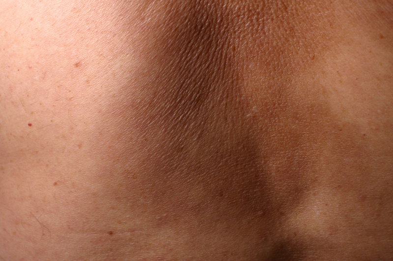 Atrofodermia Vermiculata Anexo:Enfermedades Cutáneas Wikipedia, La