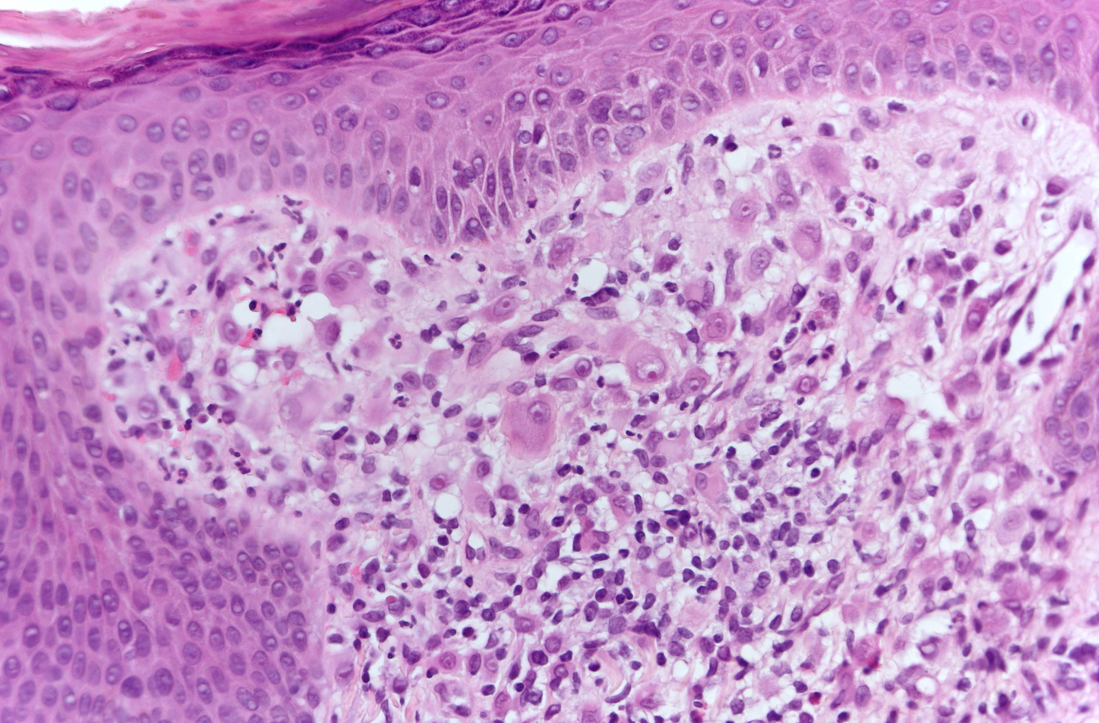 Benign cephalic histiocytosis (infantile papular self-healing ...