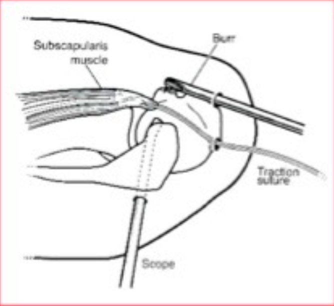Subscapularis Tendon Tear Orthopaedicprinciplescom