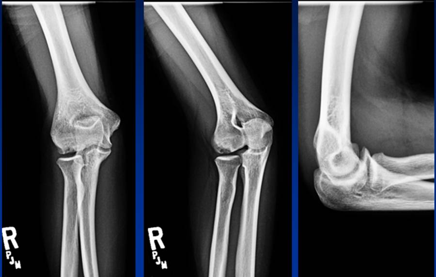 Elbow osteochondritis dissecans - The Clinical Advisor