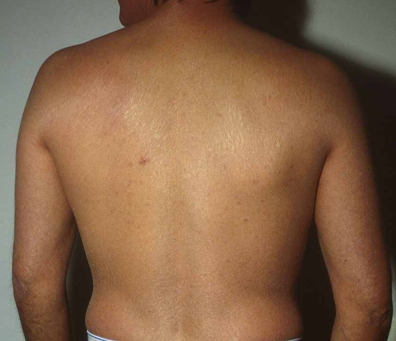 Congenital Ichthyosiform Erythroderma Nonbullous Congenital