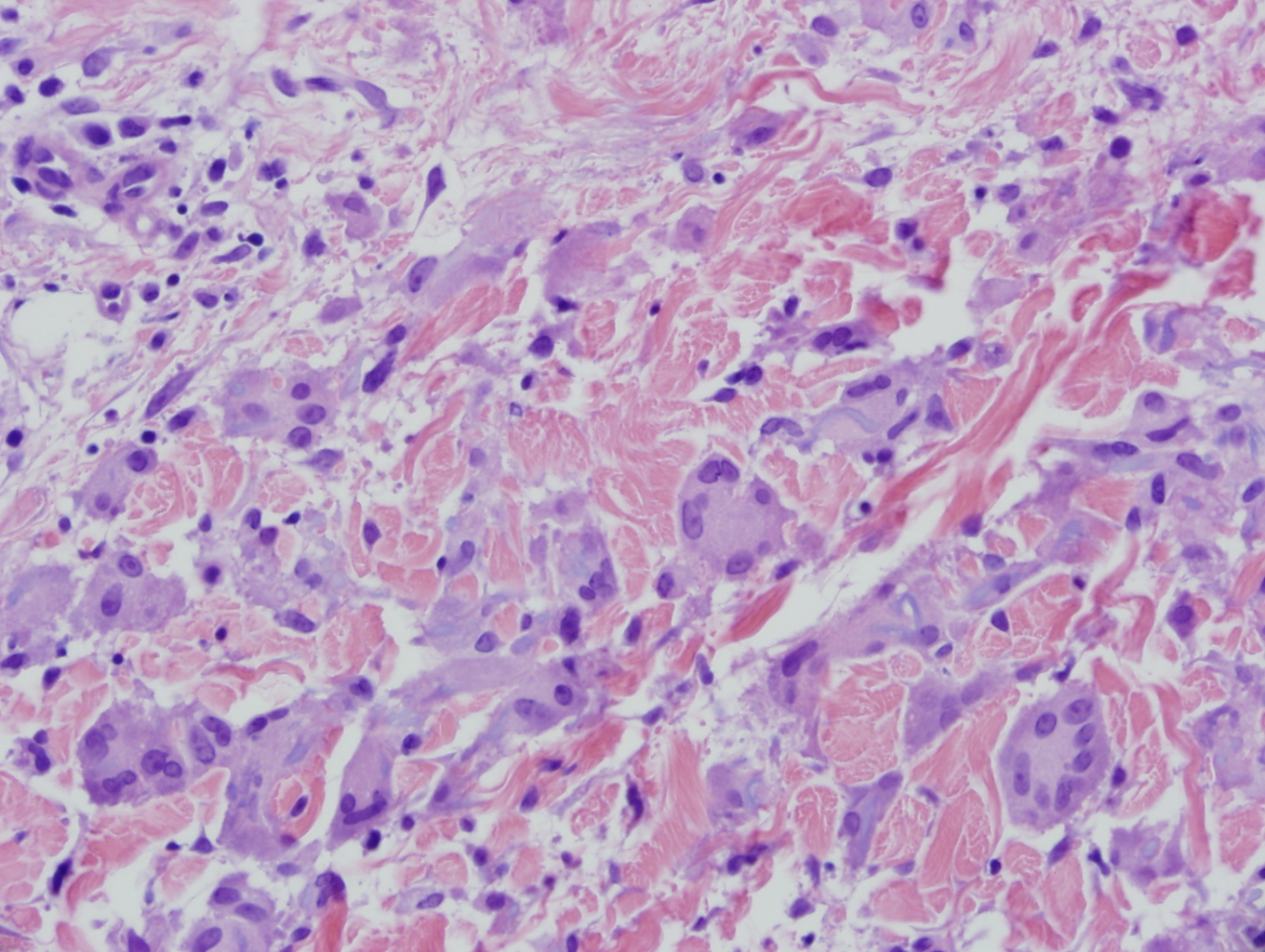 Coccidioidomycosis (Valley fever) - The Clinical Advisor