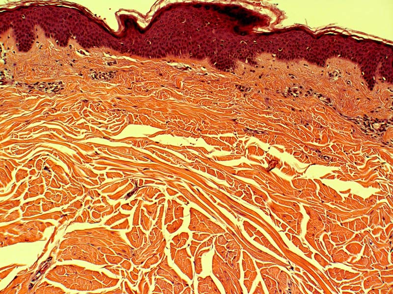 Connective tissue nevus (collagenoma, elastoma, nevus mucinosis) - The ...