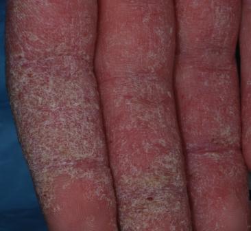 Crusted (exaggerated, Norwegian) scabies - The Clinical Advisor