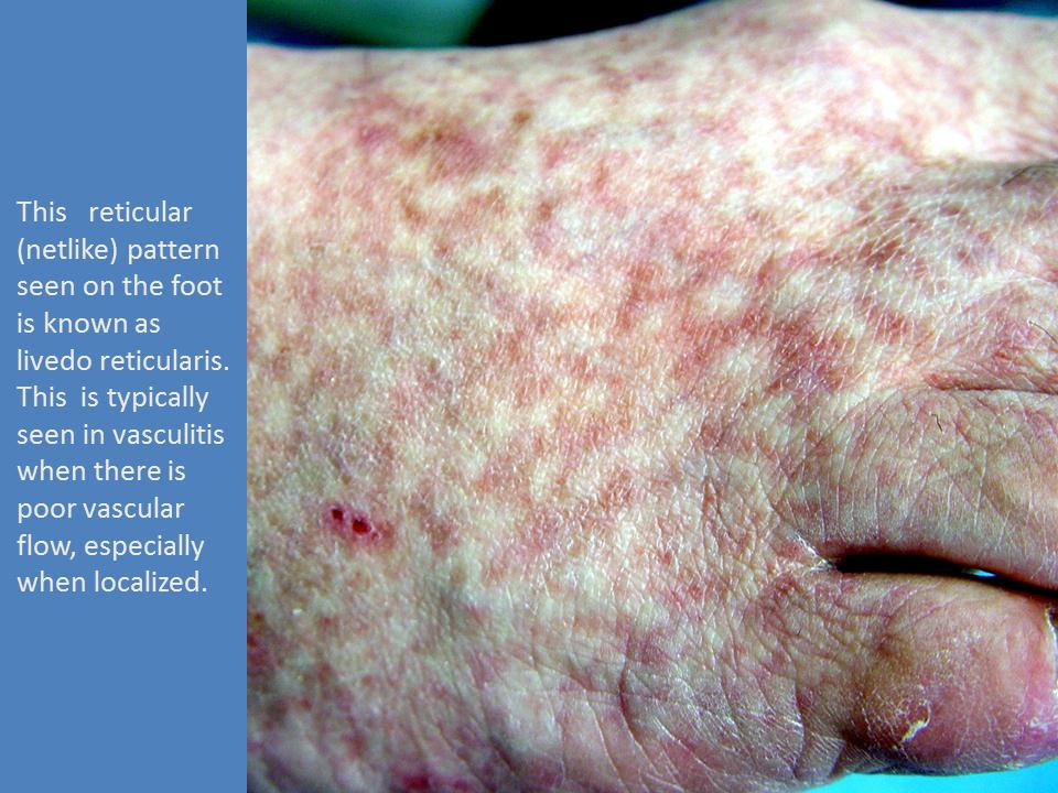 Cryofibrinogenemia (cold-related gelling or agglutination, Cutaneous ...