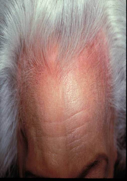 Dermatomyositis - The Clinical Advisor