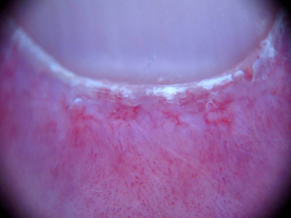 Dermatomyositis - The Clinical Advisor