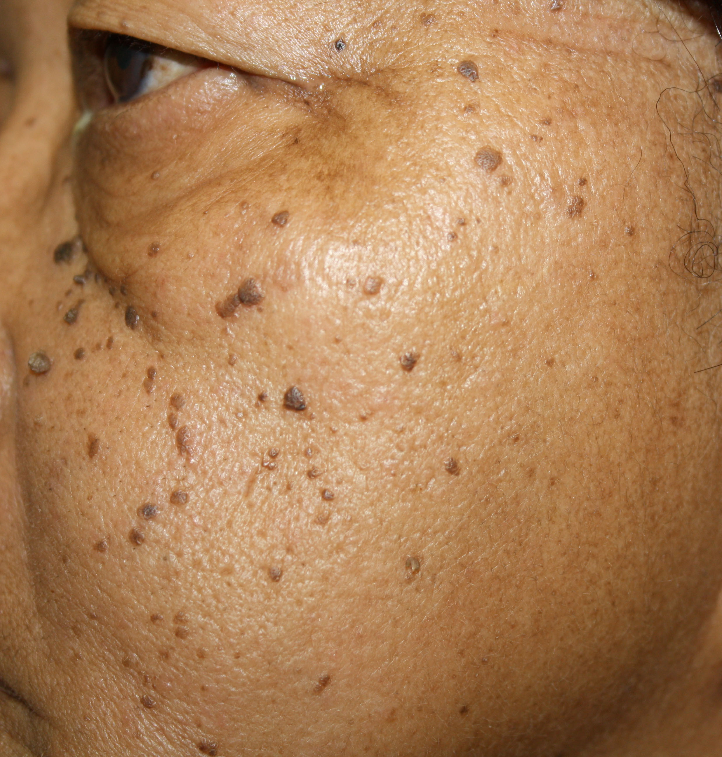 Dermatosis papulosa nigra - The Clinical Advisor