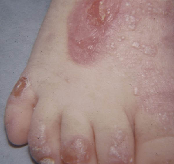 Epidermolysis Bullosa Simplex (localized EBS; Weber-Cockayne; Dowling ...