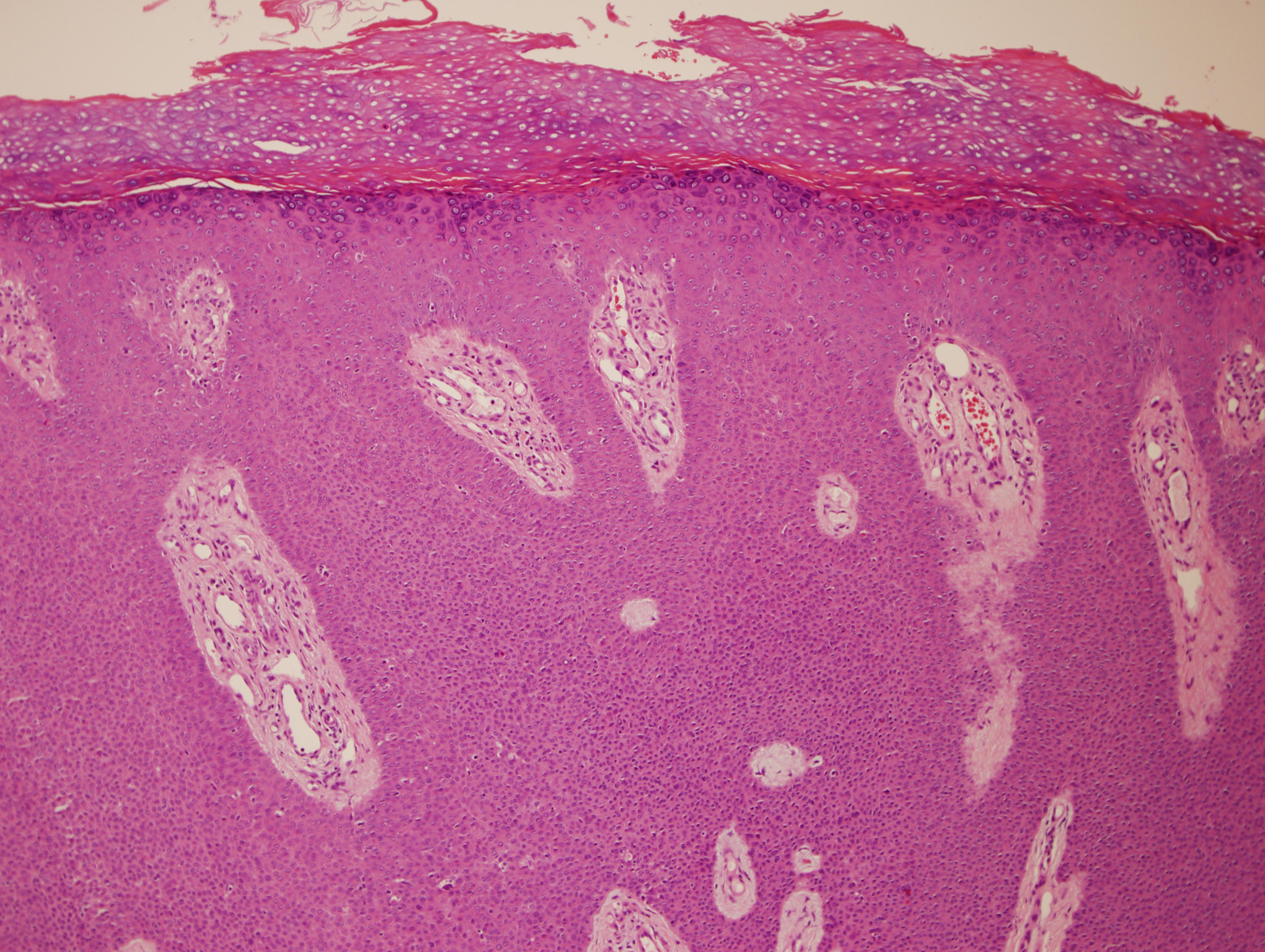 Poroma (Eccrine Poroma, Hidroacanthoma Simplex, Dermal Duct Tumor ...