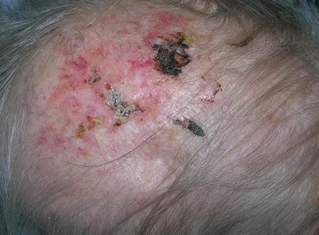 Erosive Pustular Dermatitis Of The Scalp (Erosive pustulosis of the ...