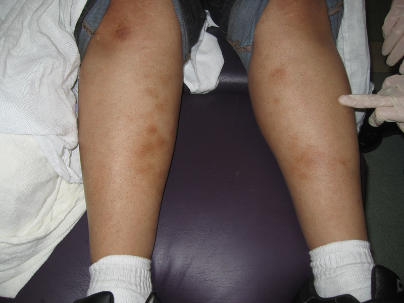 Edematous Erythema Subcutaneous Plaques And Severe Pain